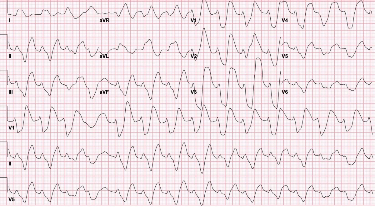 hiperK e ECG – Emergência Rules
